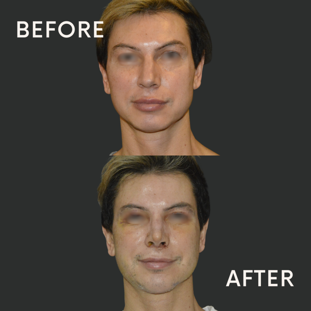 Bichectomy in Turkey | Sculpt Your Face with Dr. Celal Alioglu