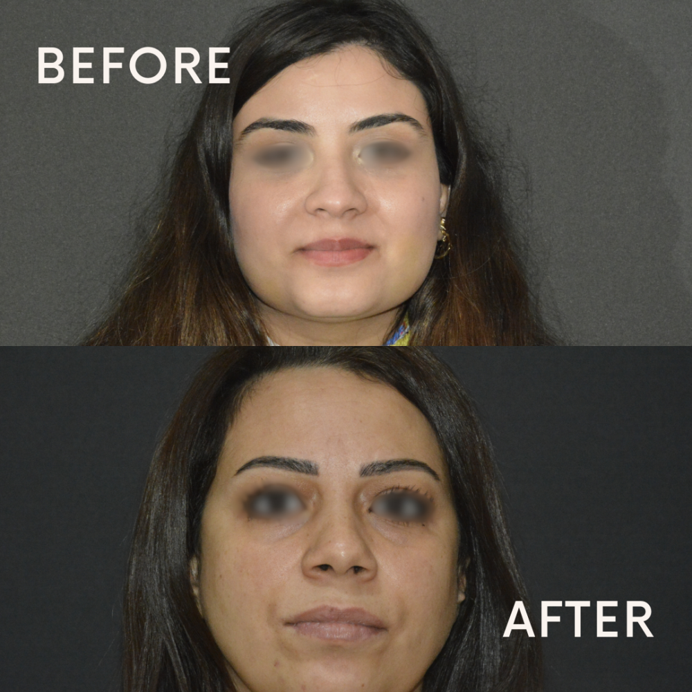 Bichectomy in Turkey | Sculpt Your Face with Dr. Celal Alioglu