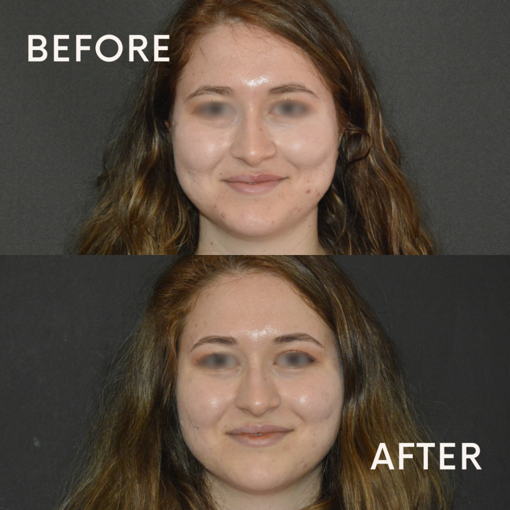 Bichectomy in Turkey | Sculpt Your Face with Dr. Celal Alioglu