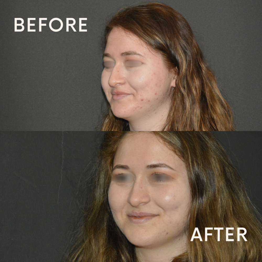 Bichectomy in Turkey | Sculpt Your Face with Dr. Celal Alioglu